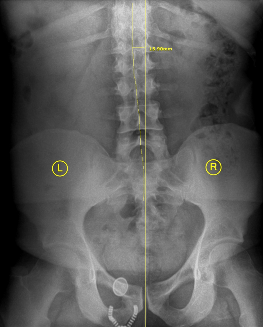 Lower Back Pain - Advanced Health Chiropractic